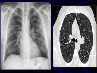 Radiological signs in chest medicine Part 1 | PDF