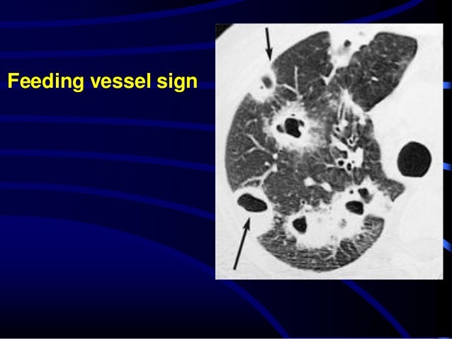 Radiological signs in chest medicine Part 1