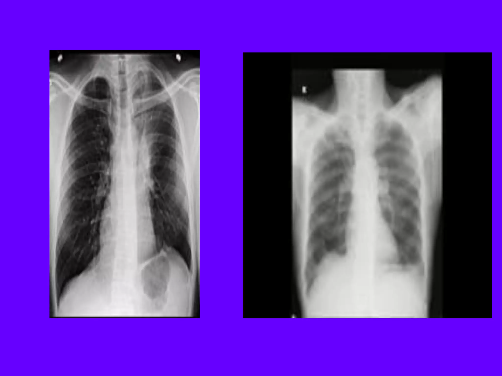 Radiological signs in chest medicine part 2 | PDF