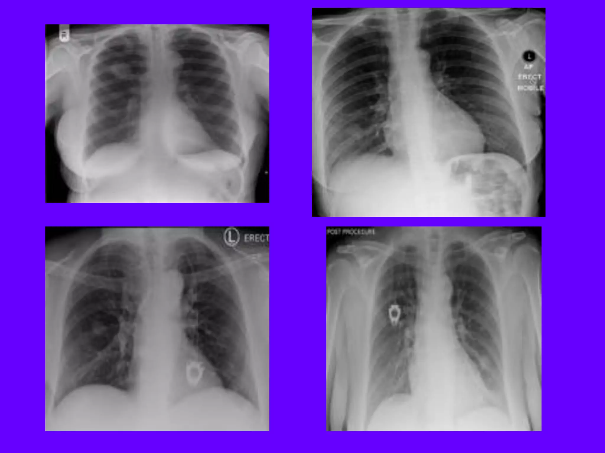 Radiological signs in chest medicine part 2 | PDF | Lung and ...