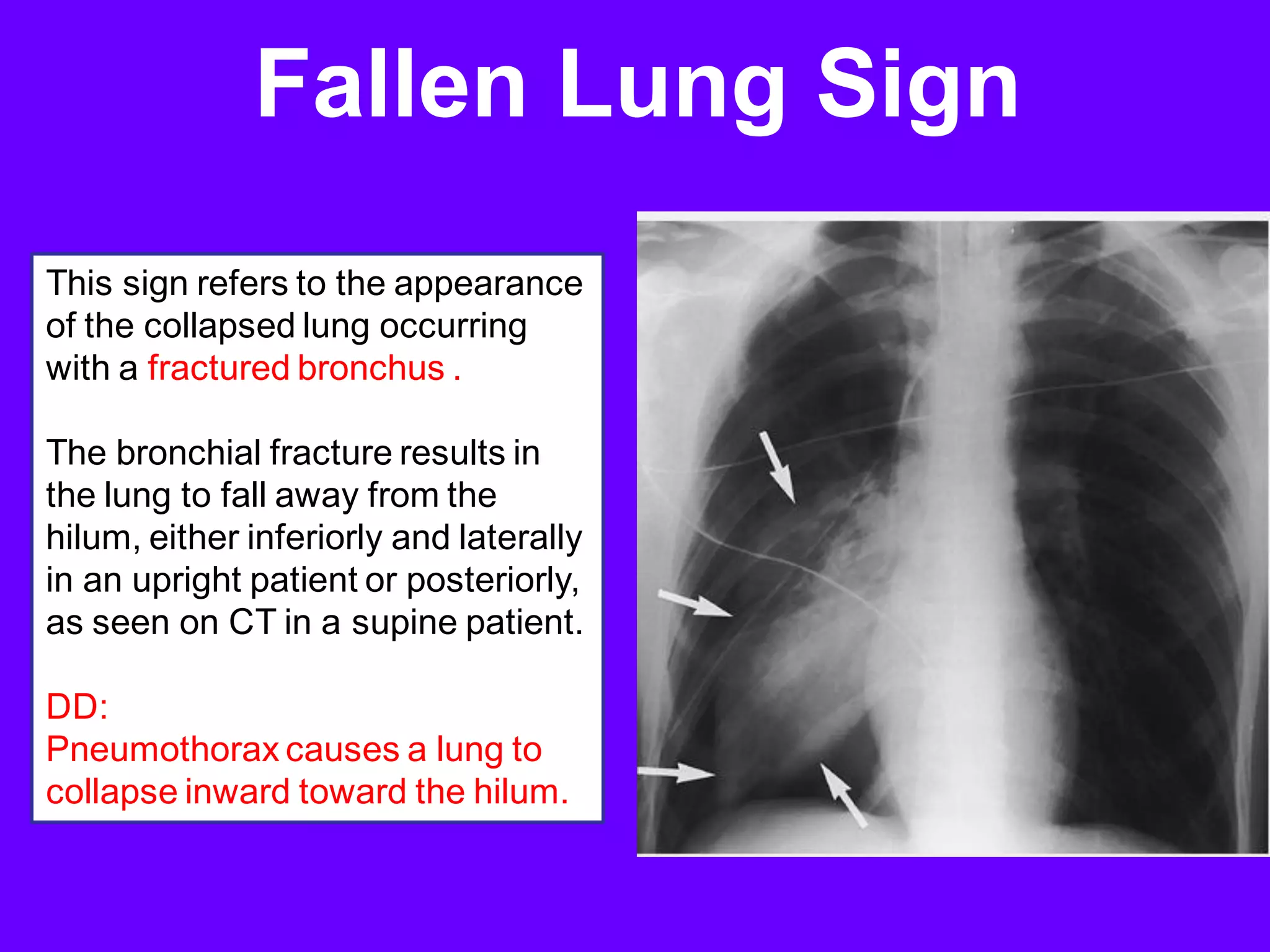 Radiological signs in chest medicine part 2 | PDF | Lung and ...