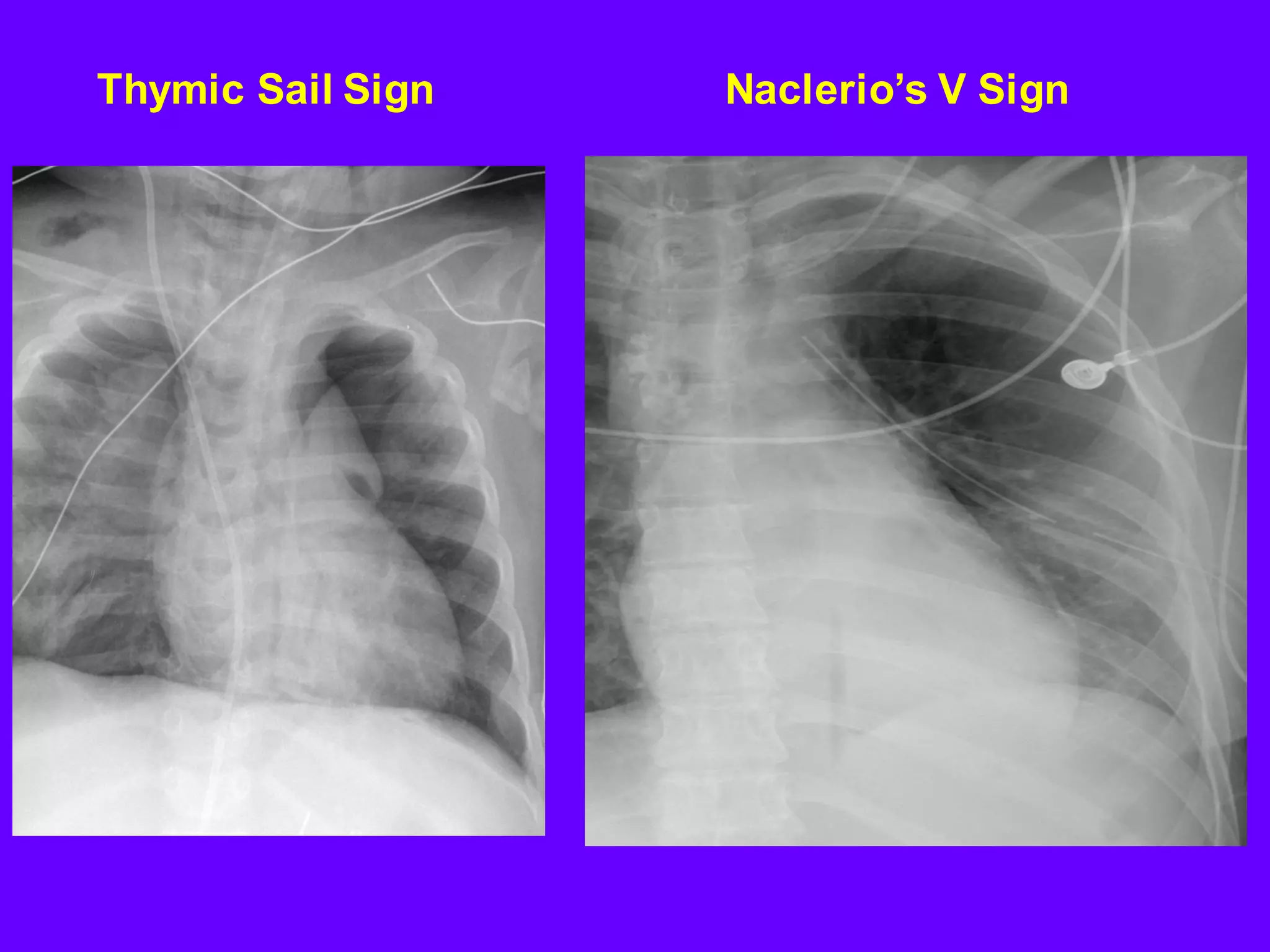 Radiological signs in chest medicine part 2 | PDF | Lung and ...