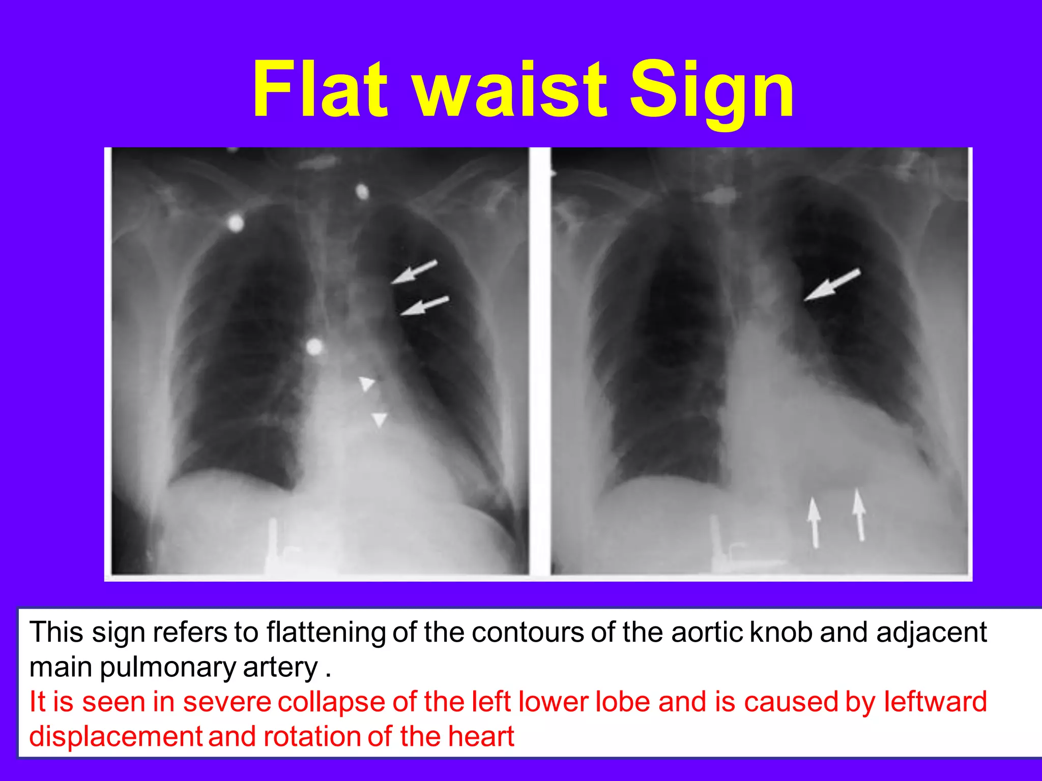 Radiological signs in chest medicine part 2 | PDF | Lung and ...