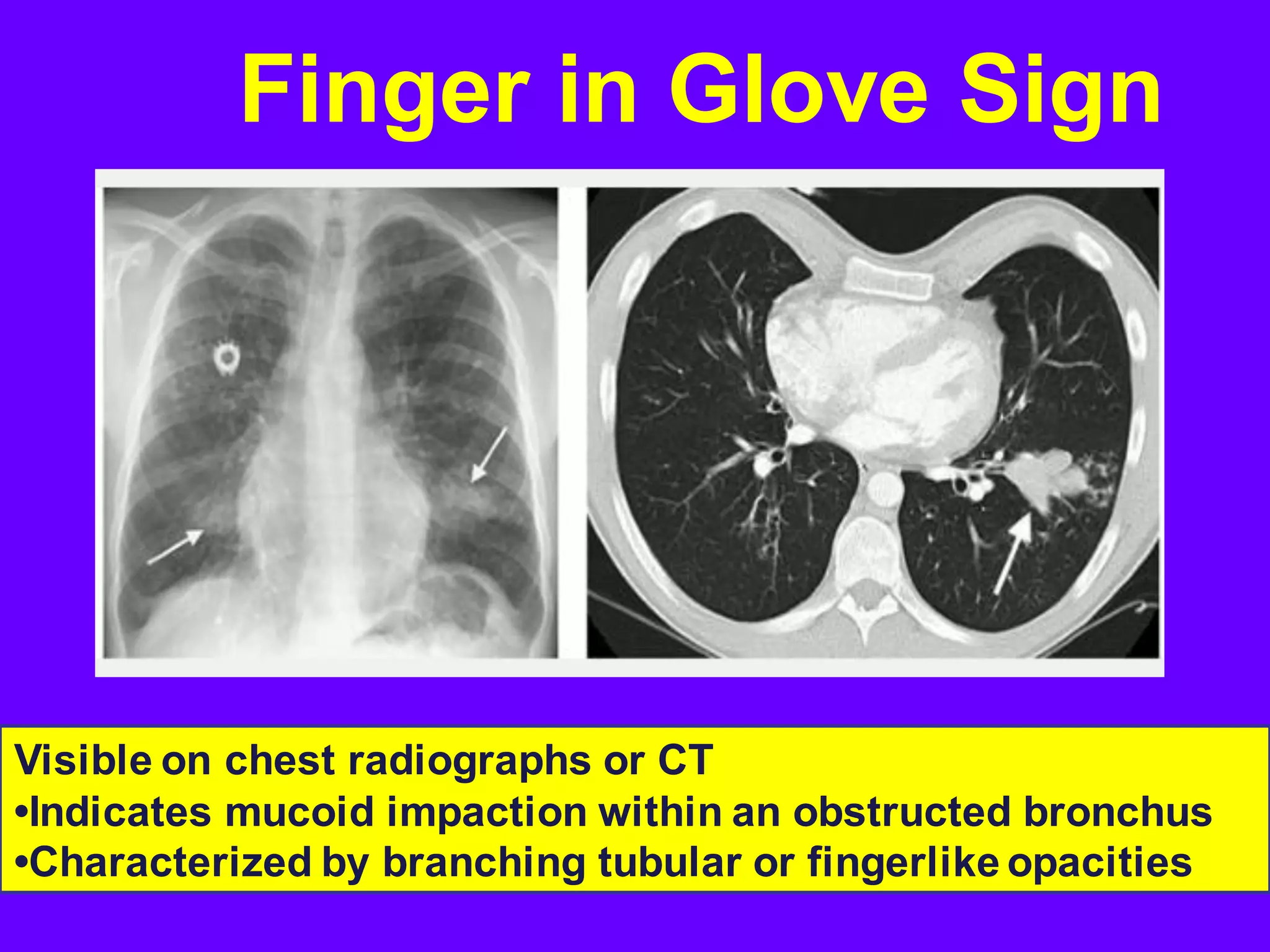 Radiological signs in chest medicine part 2 | PDF