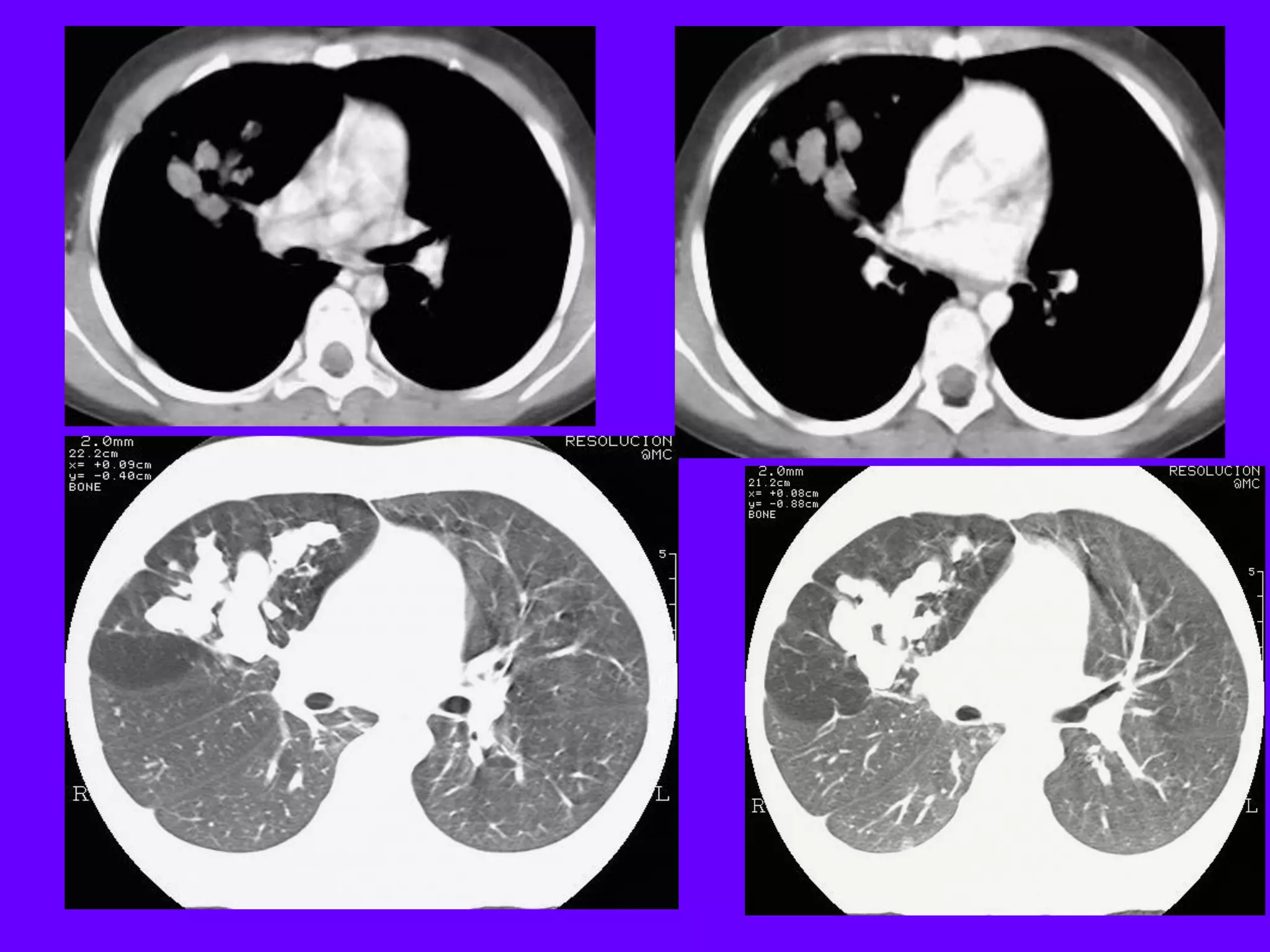 Radiological signs in chest medicine part 2 | PDF
