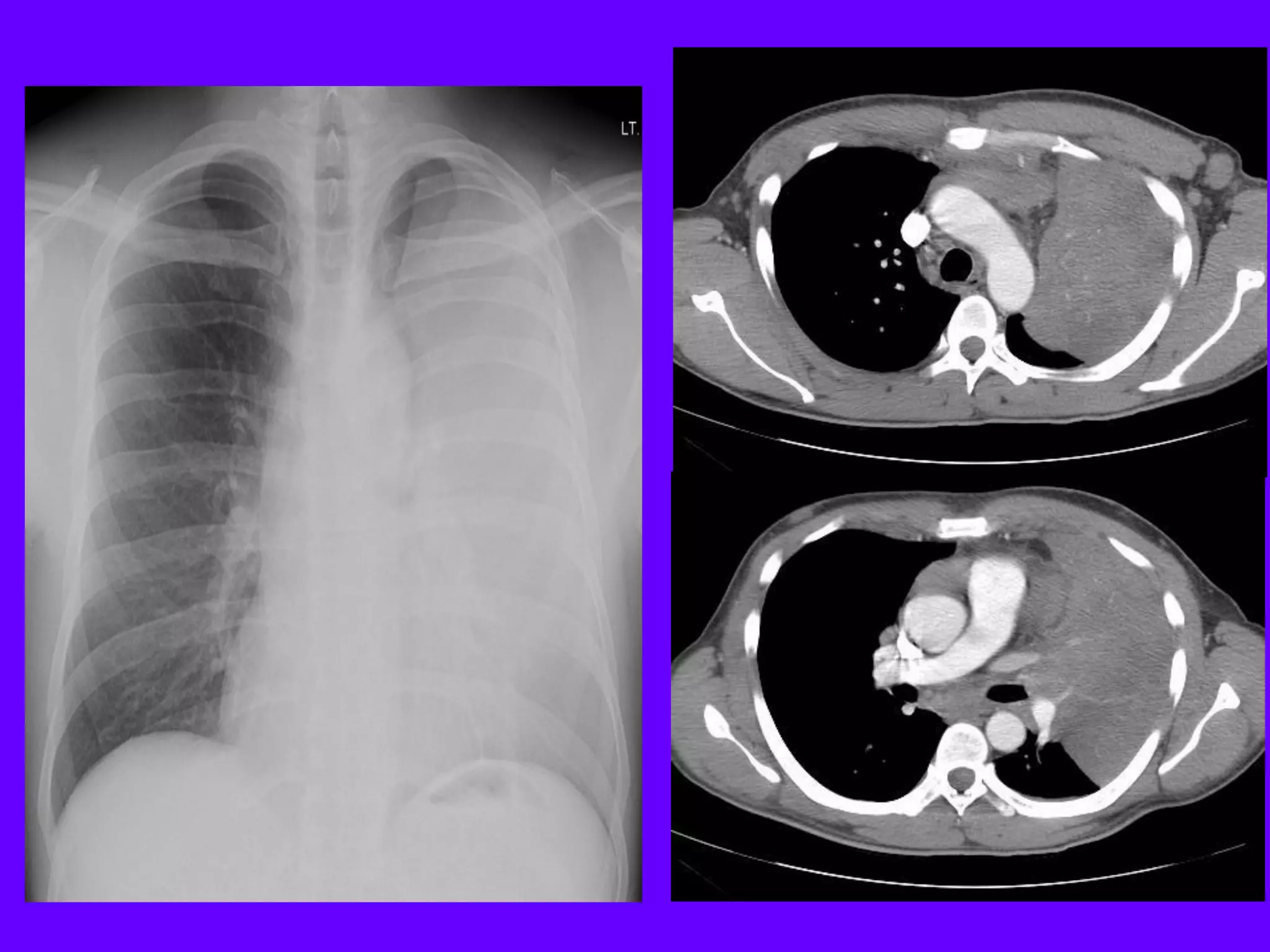Radiological signs in chest medicine part 2 | PDF