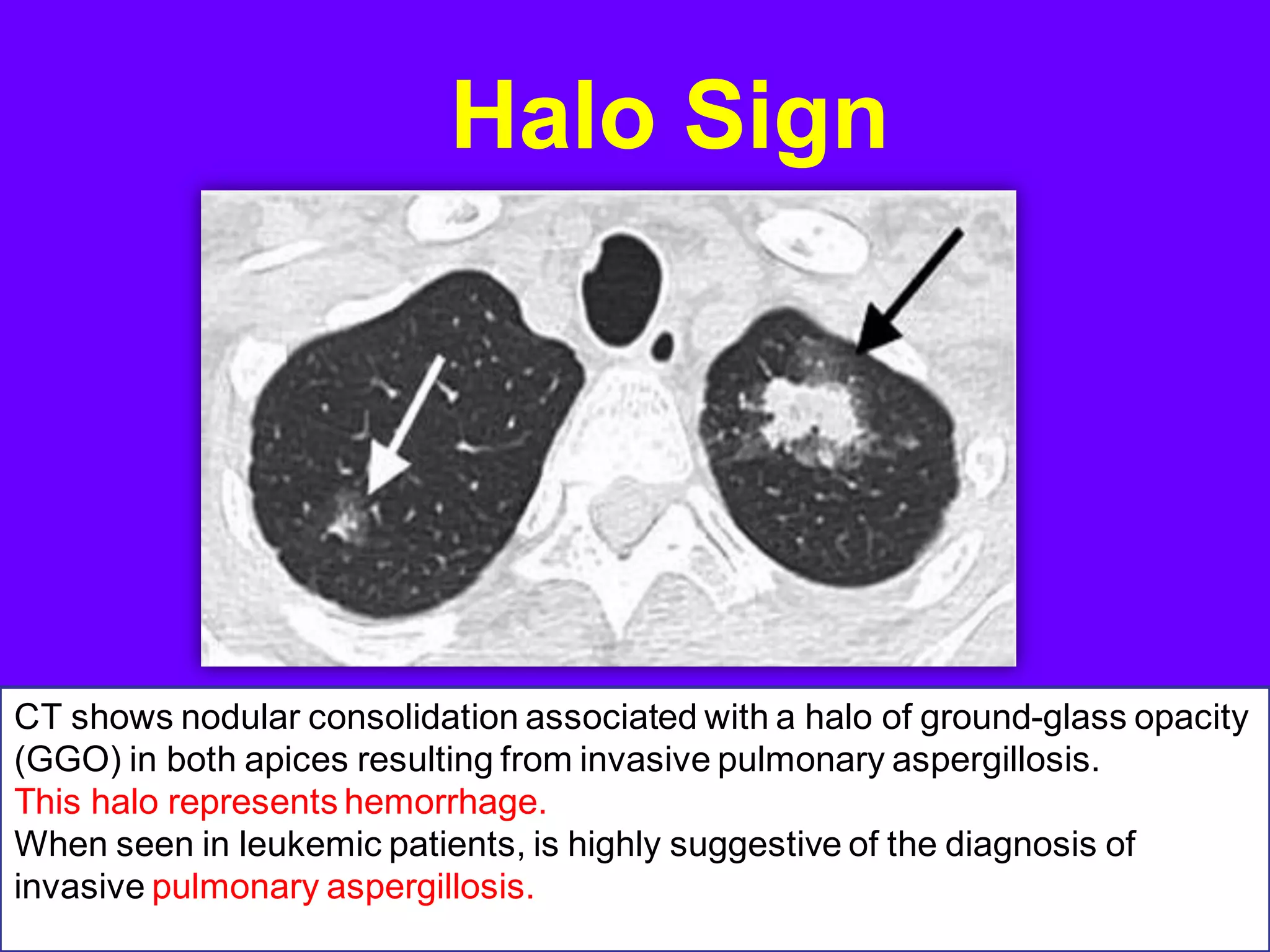 Radiological signs in chest medicine part 2 | PDF | Lung and ...