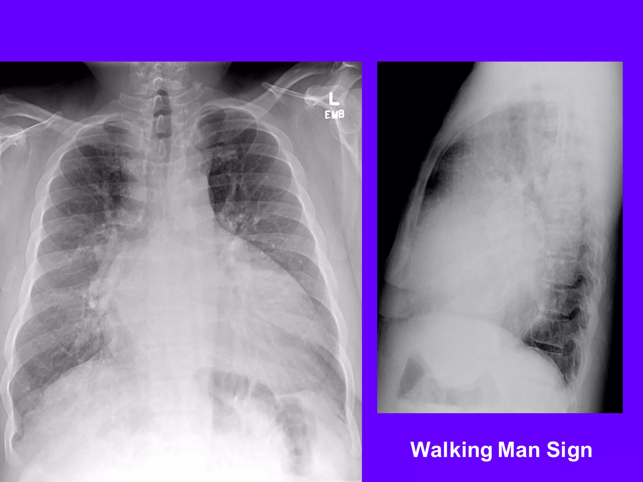 Radiological signs in chest medicine part 2 | PDF | Lung and ...