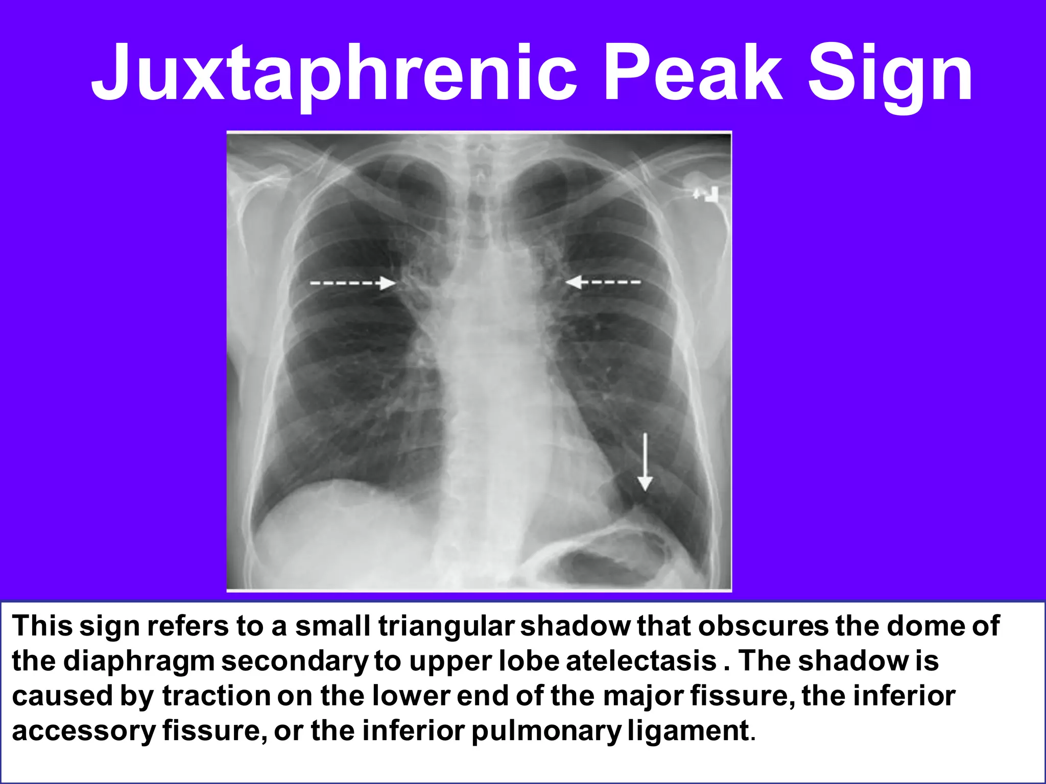 Radiological signs in chest medicine part 2 | PDF