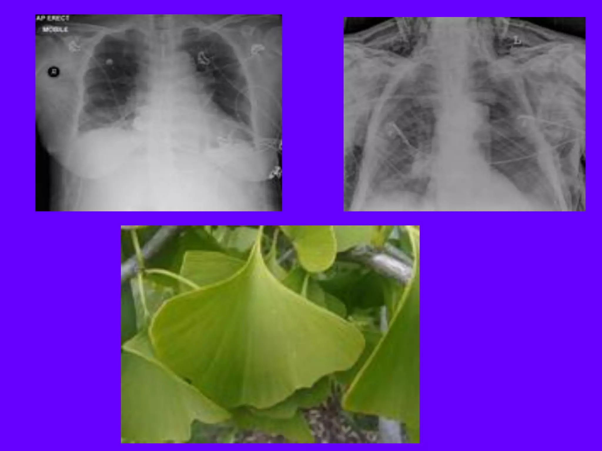 Radiological signs in chest medicine part 2 | PDF