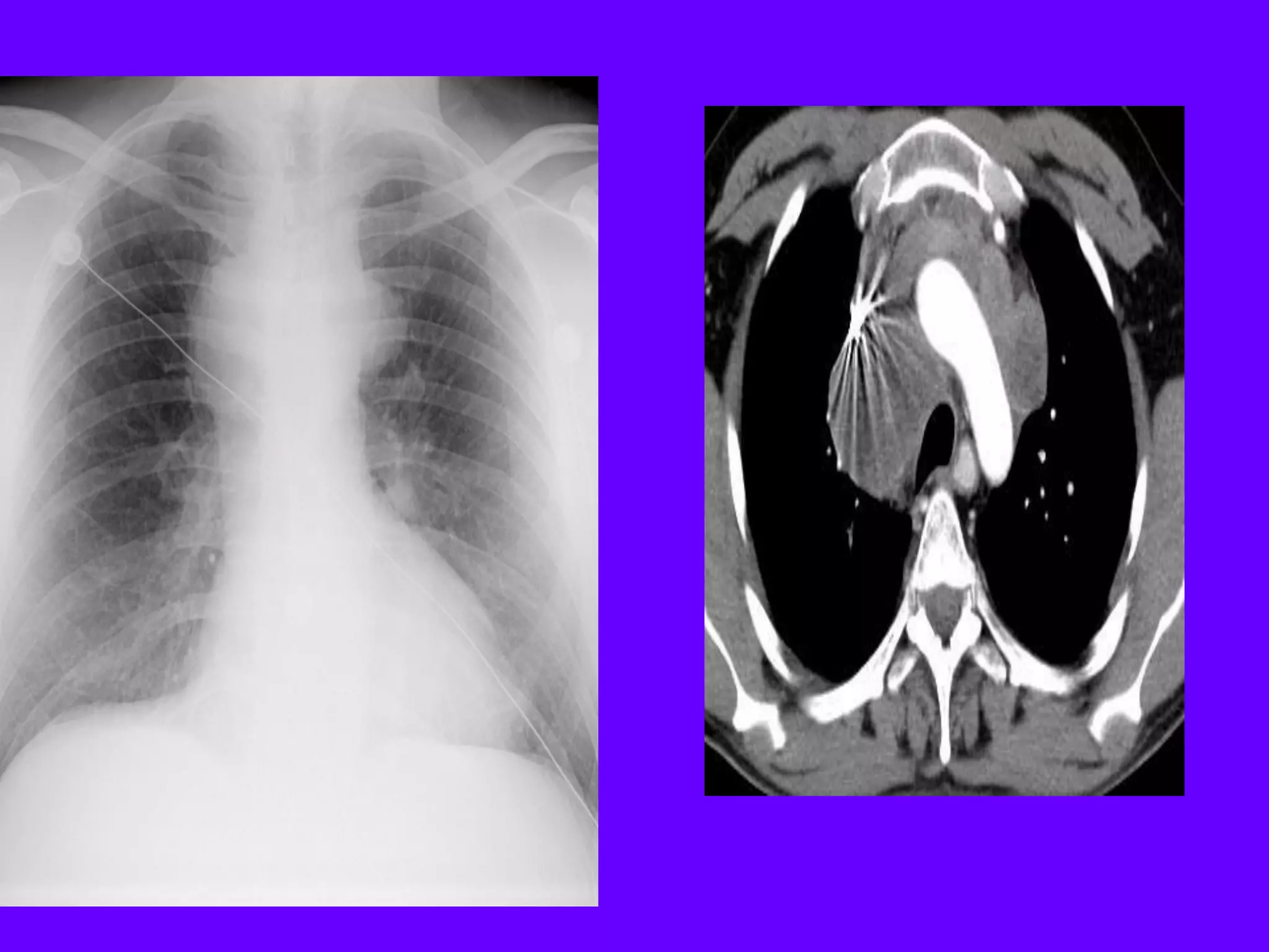 Radiological signs in chest medicine part 2 | PDF