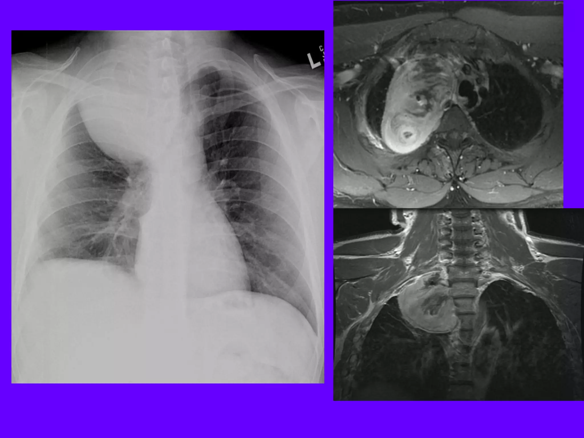 Radiological signs in chest medicine part 2 | PDF