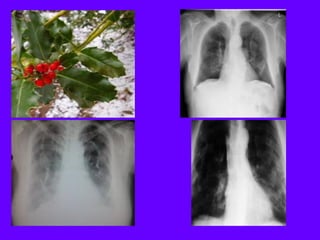 Radiological signs in chest medicine part 2 | PDF
