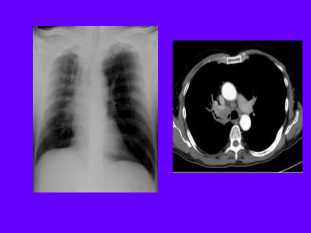 Radiological signs in chest medicine part 2 | PDF | Lung and ...