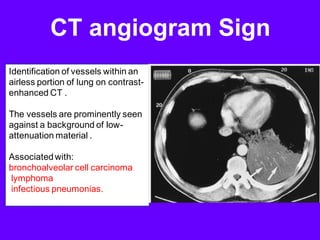 Radiological signs in chest medicine part 2 | PDF