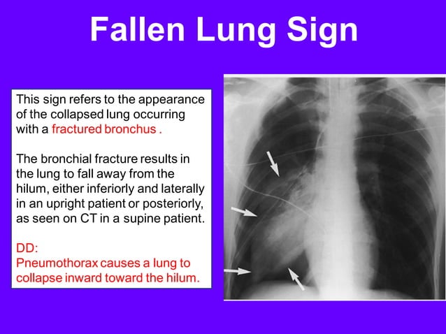 Radiological signs in chest medicine part 2 | PDF | Lung and ...