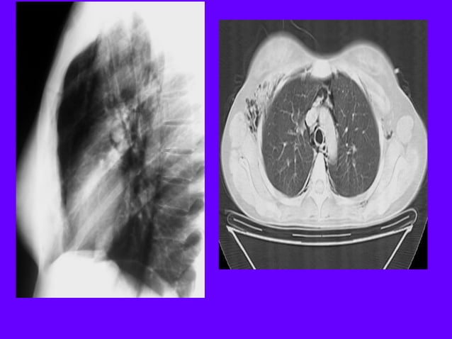 Radiological signs in chest medicine part 2 | PDF | Lung and ...