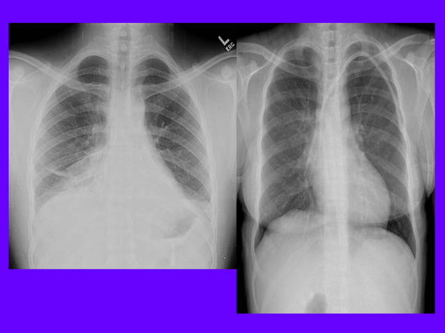 Radiological signs in chest medicine part 2 | PDF | Lung and ...