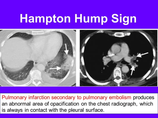 Radiological signs in chest medicine part 2 | PDF | Lung and ...