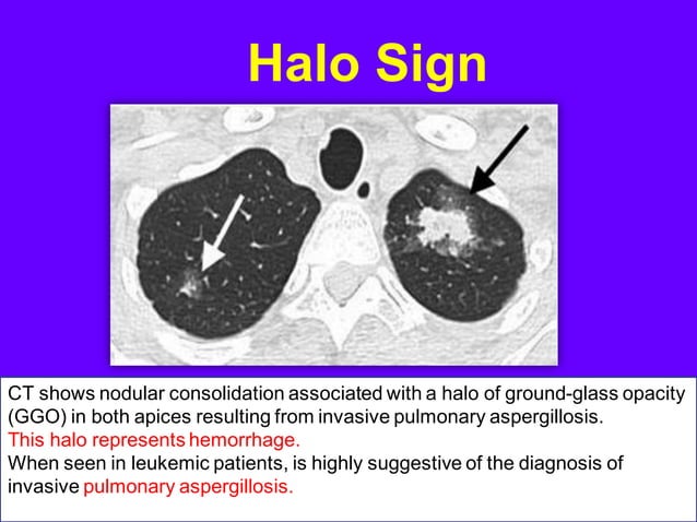 Radiological signs in chest medicine part 2 | PDF | Lung and ...
