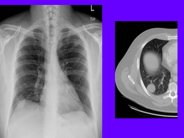 Radiological signs in chest medicine part 2 | PDF | Lung and ...