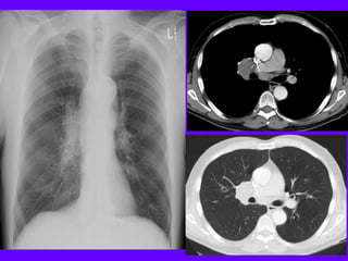 Radiological signs in chest medicine part 2 | PDF