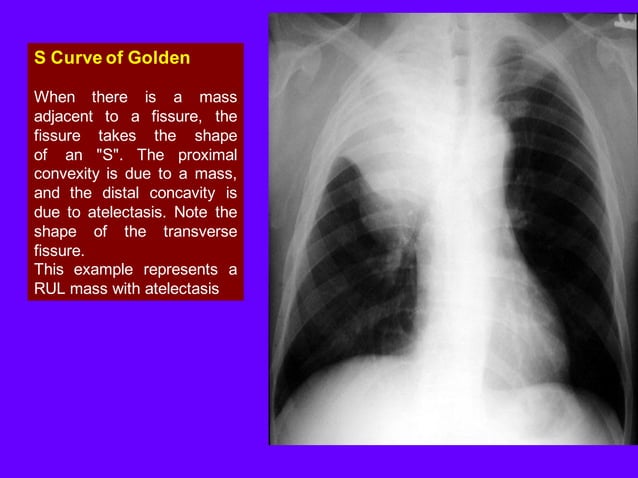 Radiological signs in chest medicine part 2 | PDF | Lung and ...