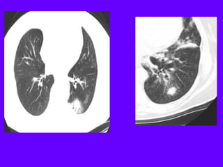 Radiological signs in chest medicine part 2 | PDF