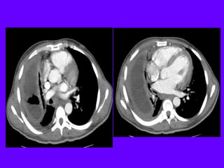 Radiological signs in chest medicine part 2 | PDF