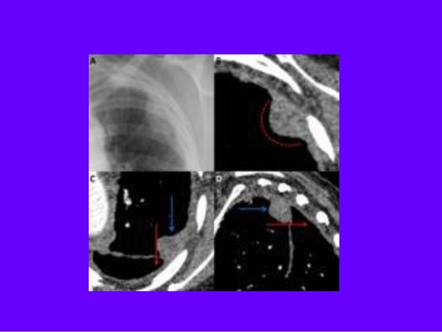 Radiological signs in chest medicine part 2