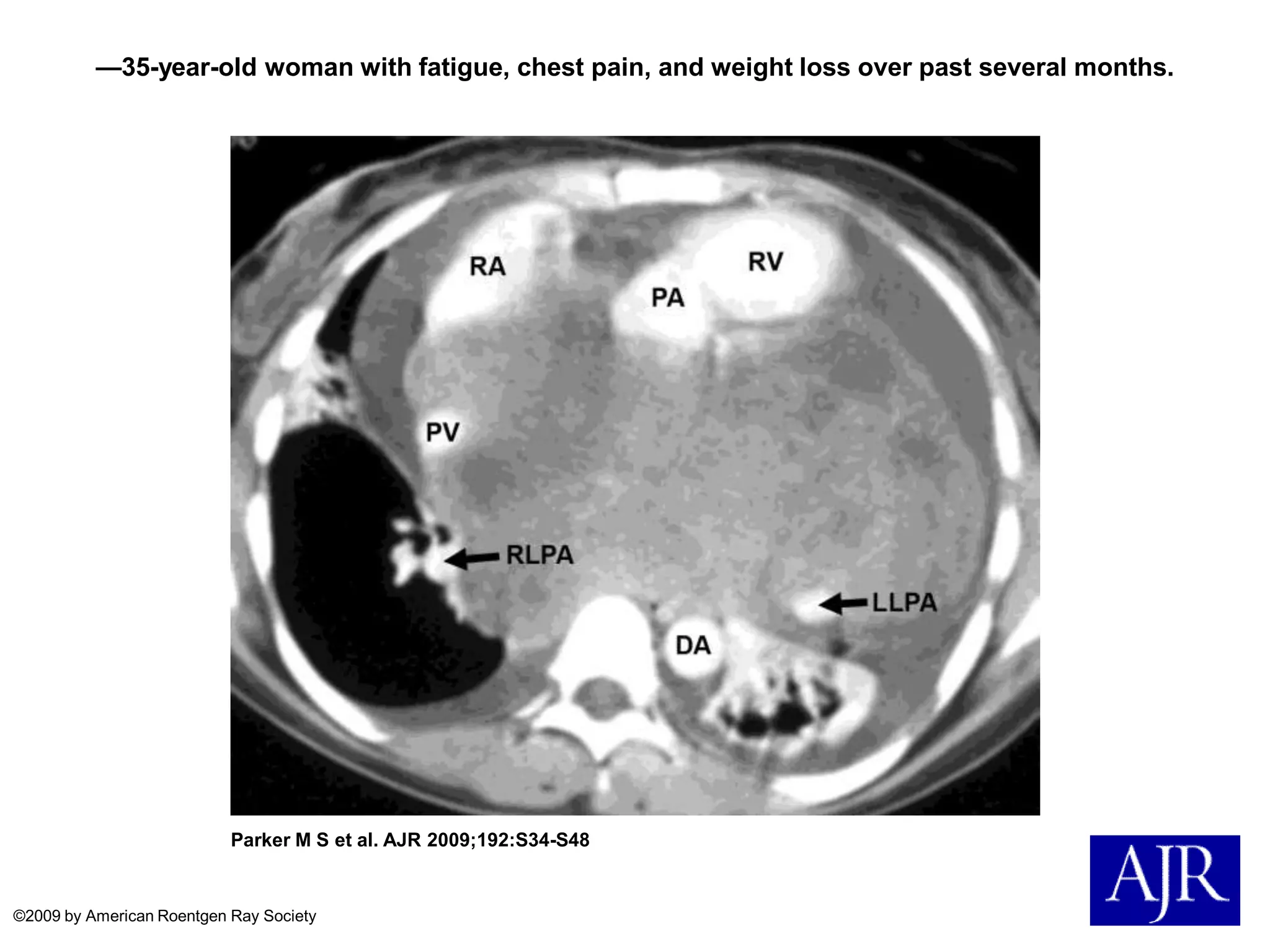 Radiological signs in thoracic imaging ( AJR article) | PPTX