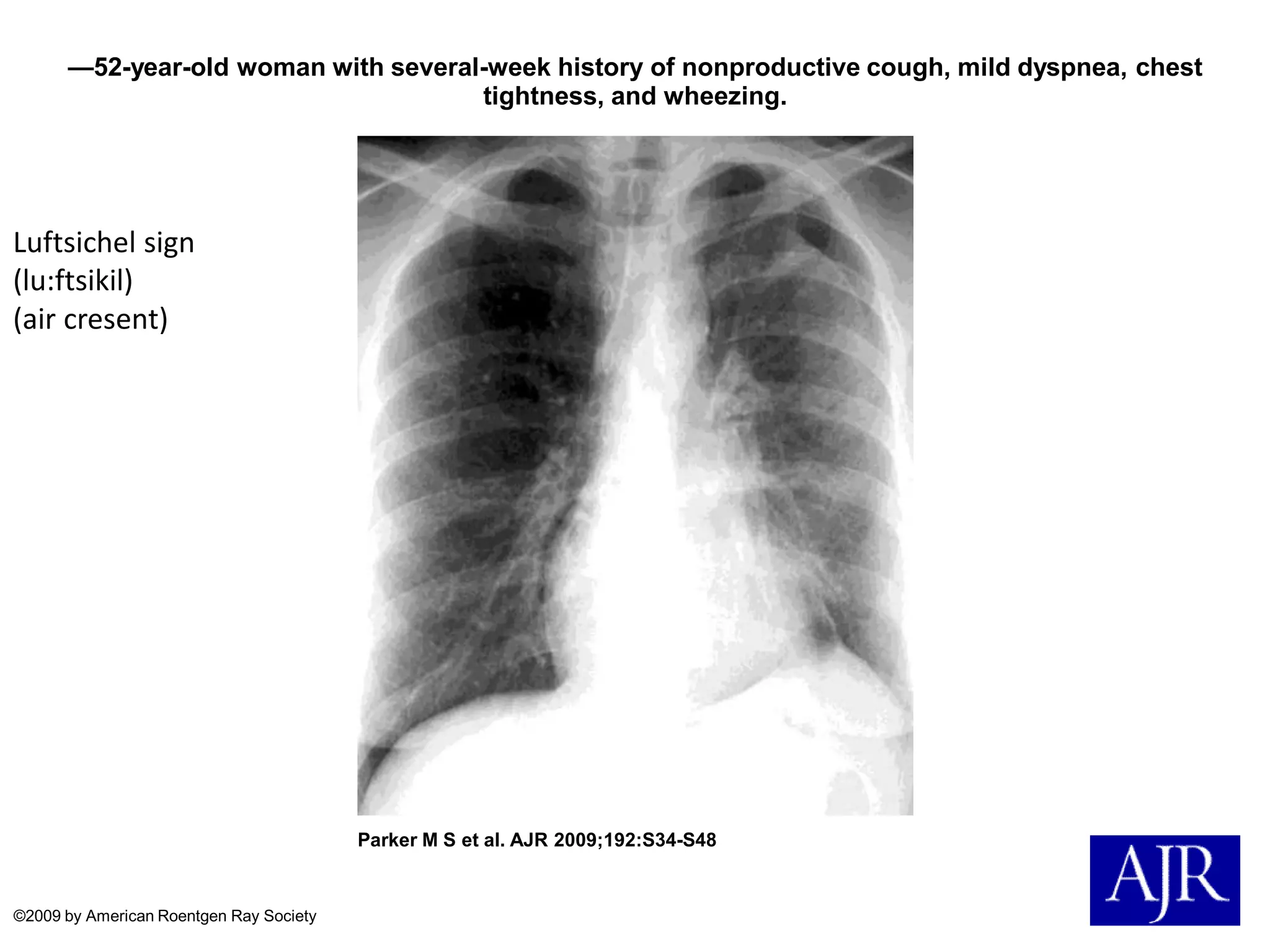 Radiological signs in thoracic imaging ( AJR article) | PPTX