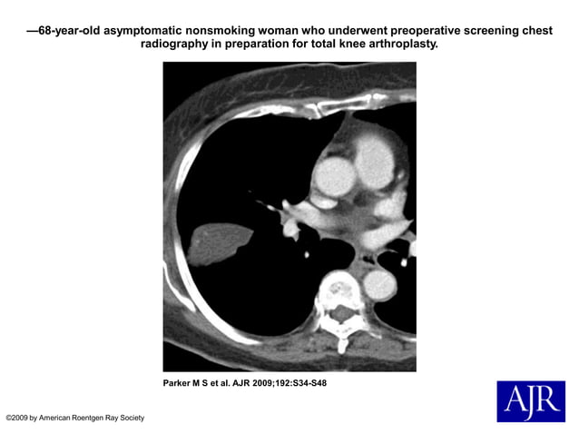 Radiological signs in thoracic imaging ( AJR article) | PPTX