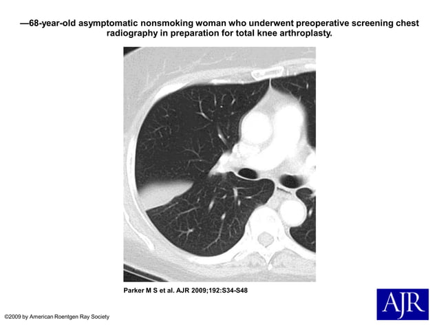 Radiological signs in thoracic imaging ( AJR article) | PPTX