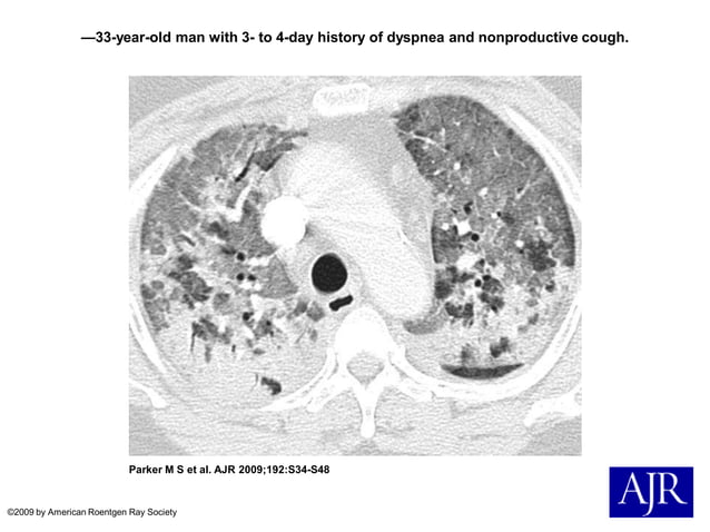 Radiological signs in thoracic imaging ( AJR article) | PPTX