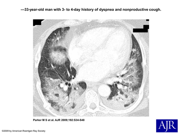 Radiological signs in thoracic imaging ( AJR article) | PPTX