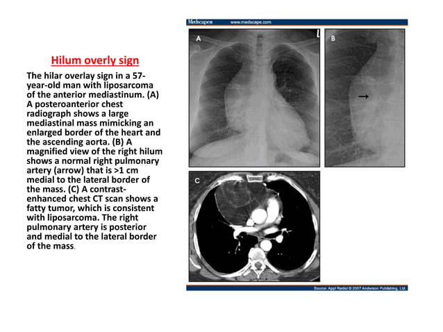 Radiological signs in thoracic imaging ( AJR article) | PPTX