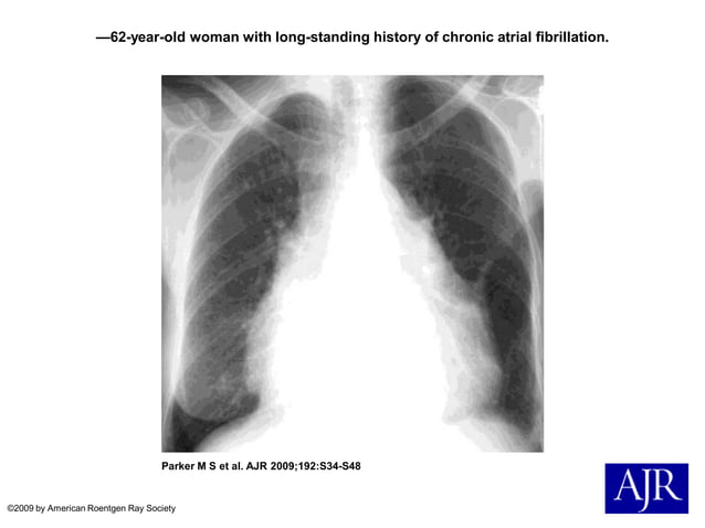 Radiological signs in thoracic imaging ( AJR article) | PPTX