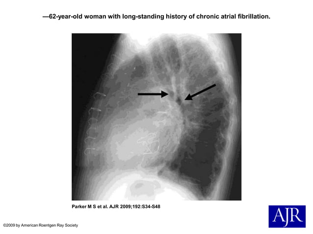 Radiological signs in thoracic imaging ( AJR article) | PPTX