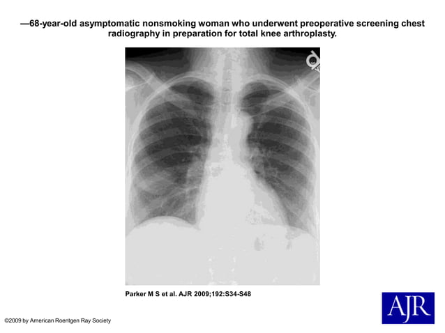 Radiological signs in thoracic imaging ( AJR article) | PPTX