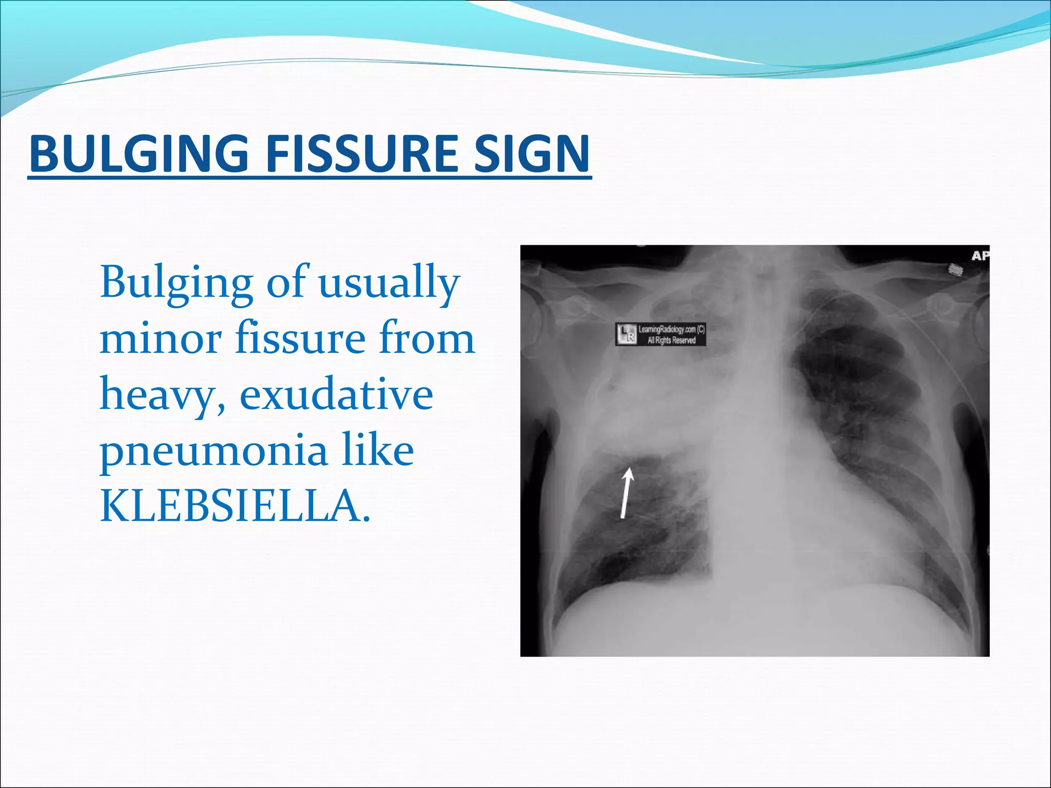 Radiology signs | PPT