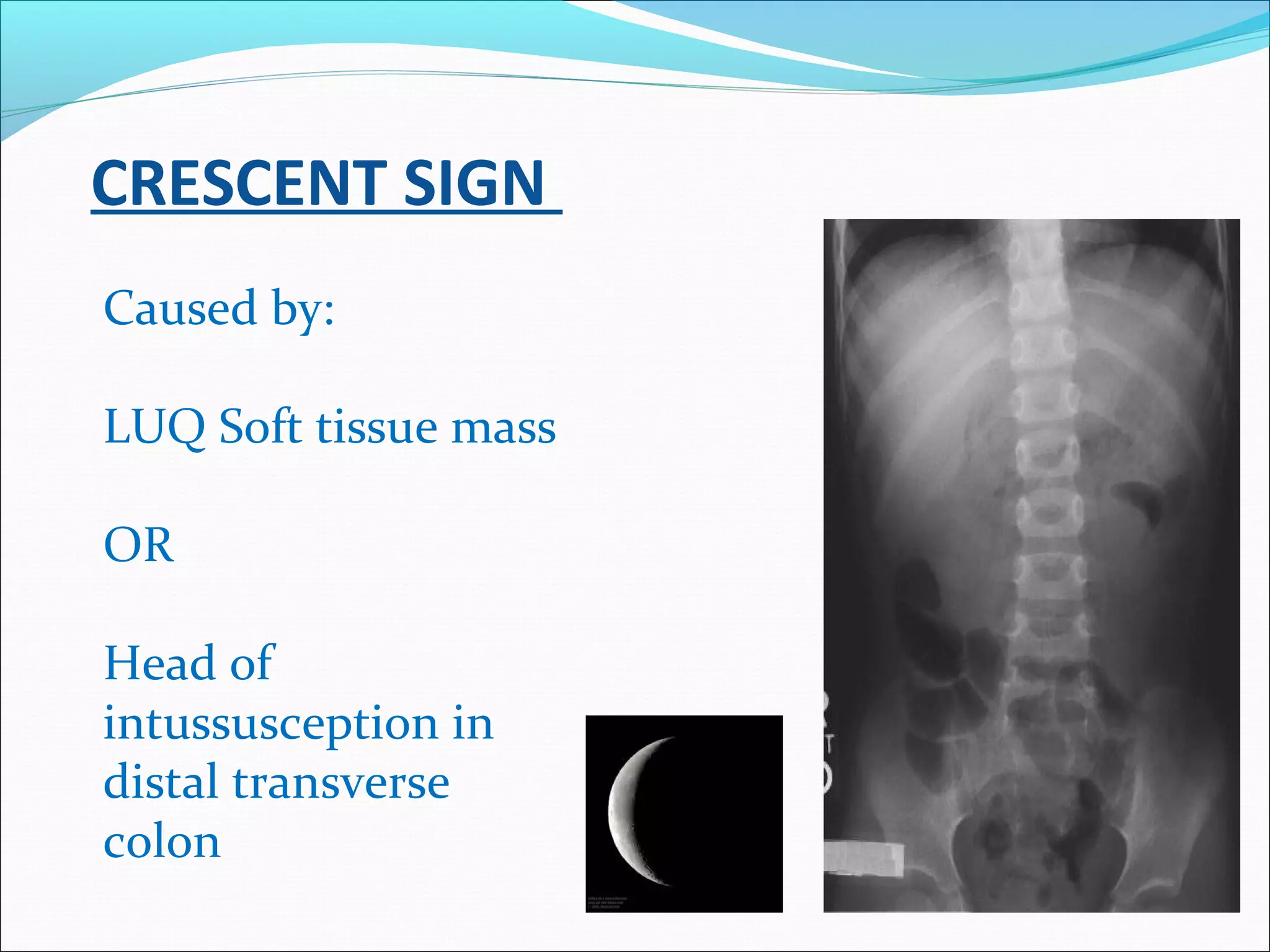 Radiology signs | PPT
