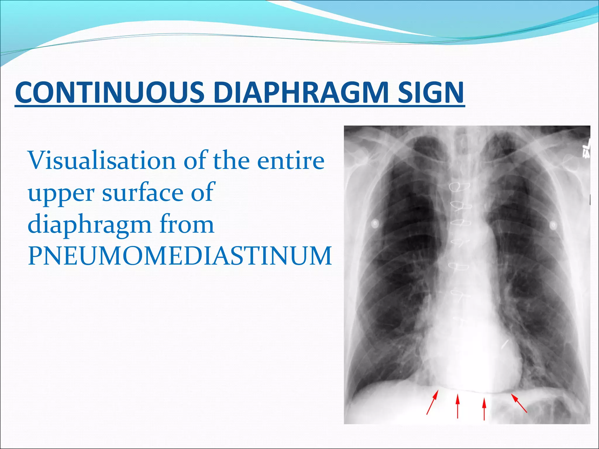 Radiology signs | PPT