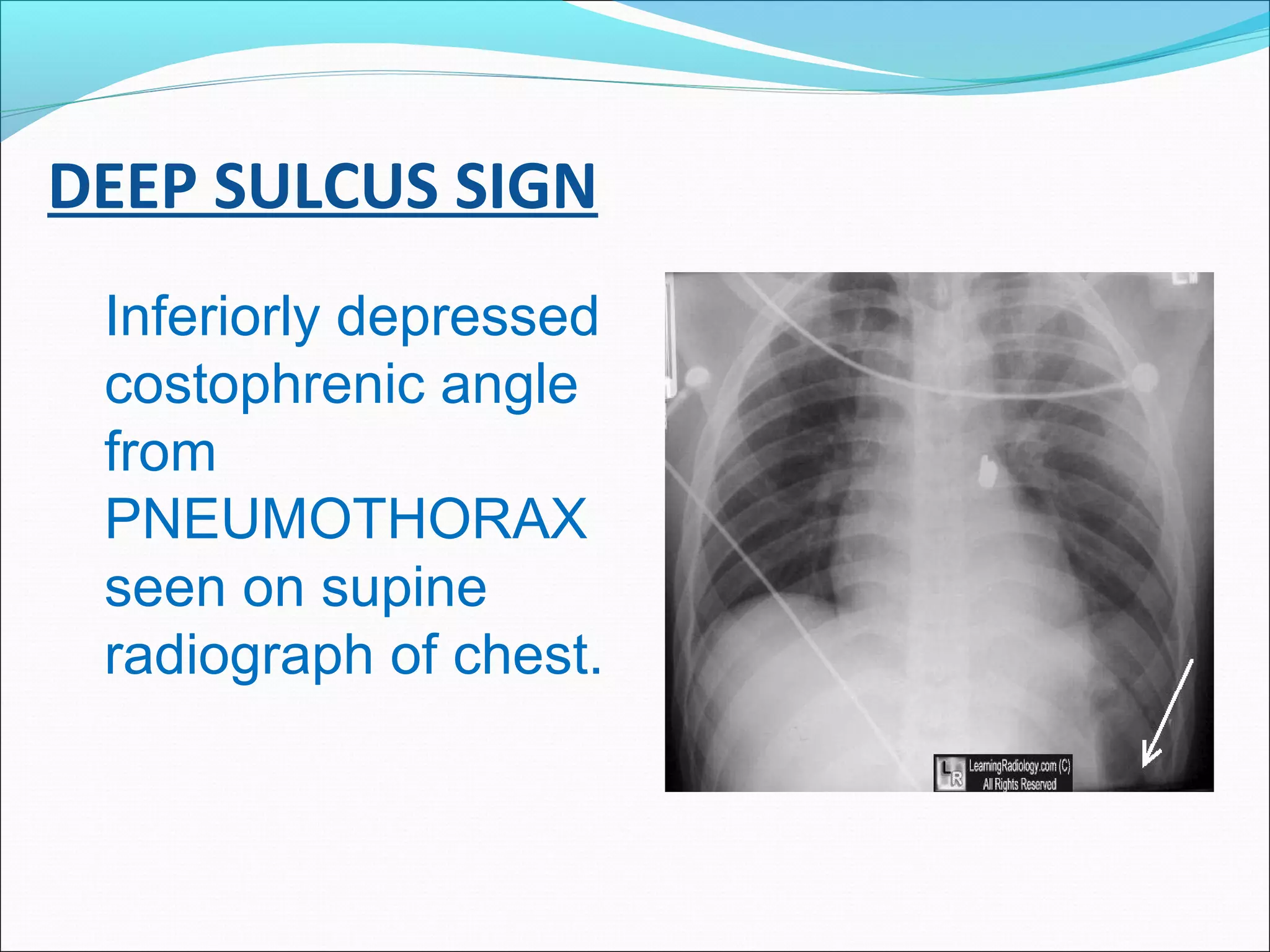 Radiology signs | PPT