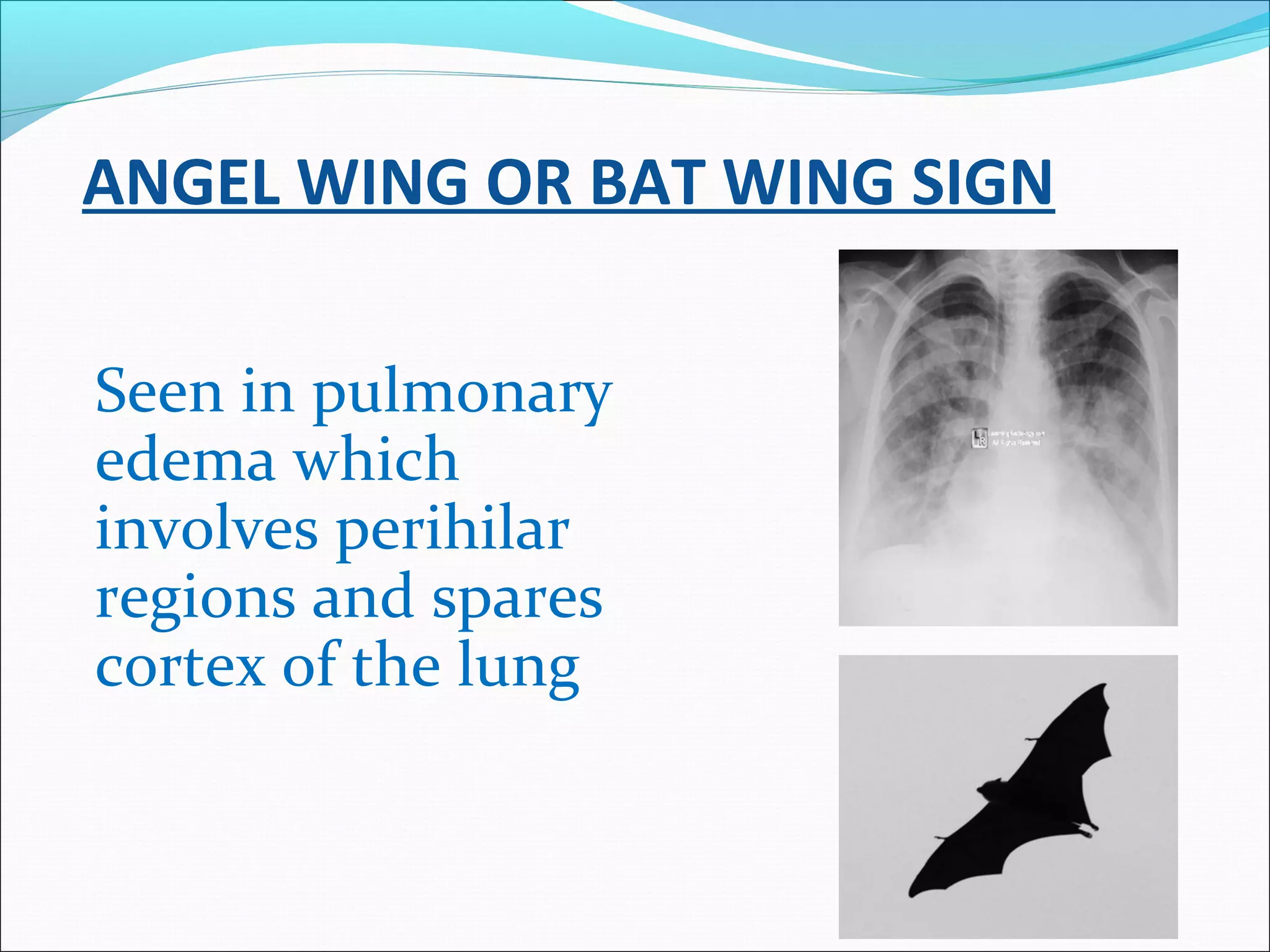 Radiology signs | PPT