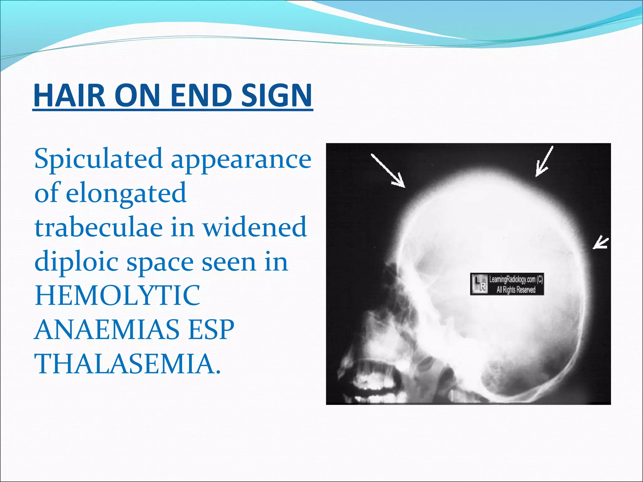 Radiology signs | PPT