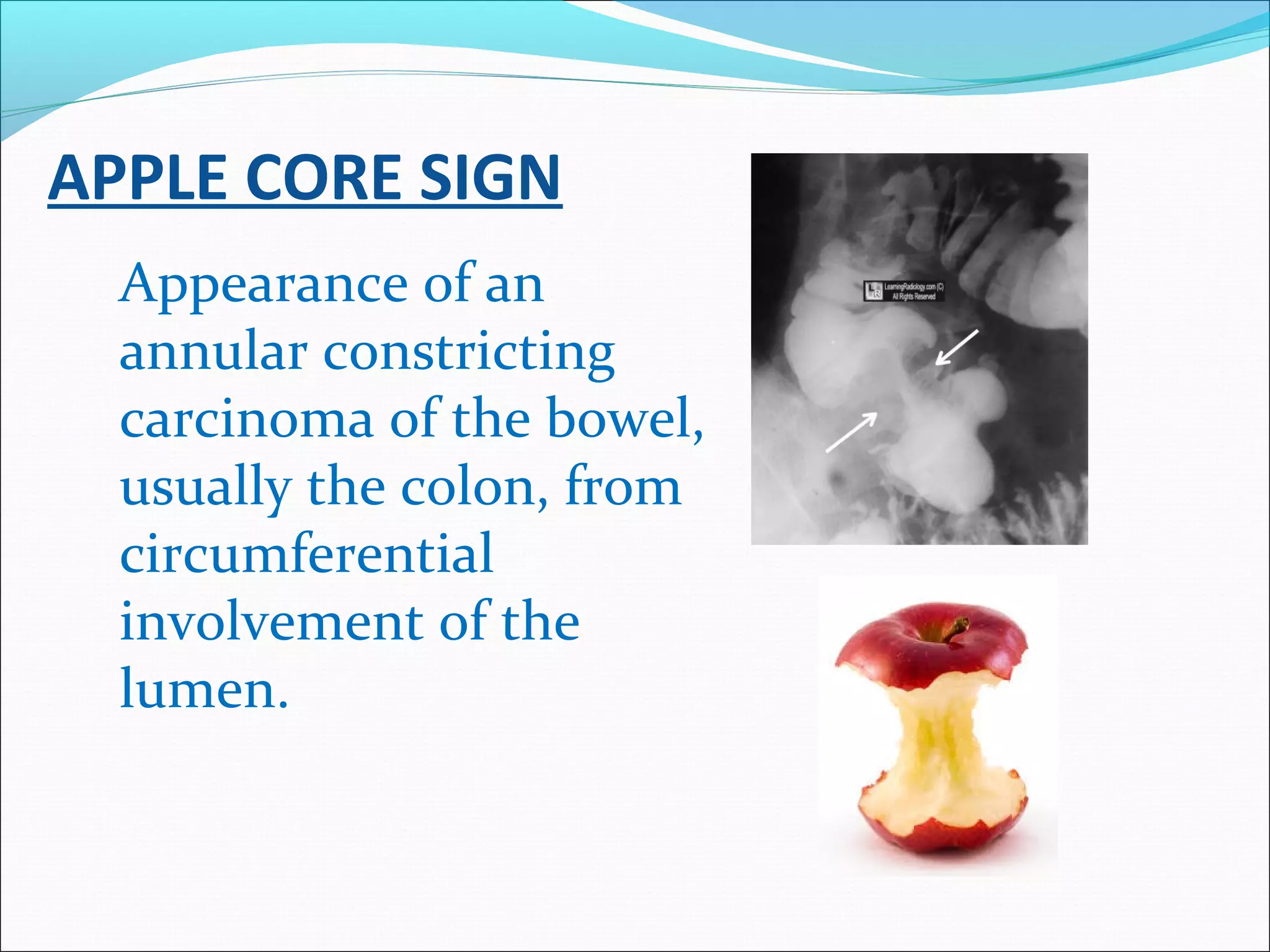 Radiology signs | PPT