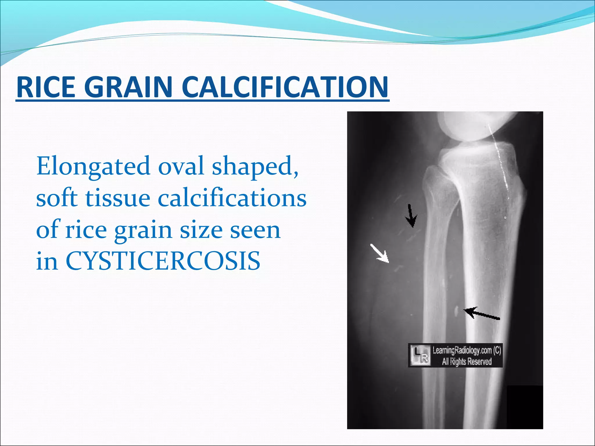 Radiology signs | PPT