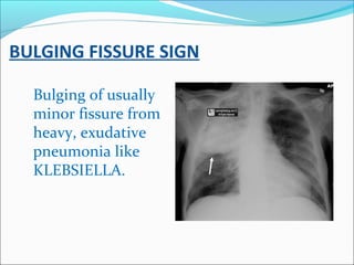Radiology signs | PPT