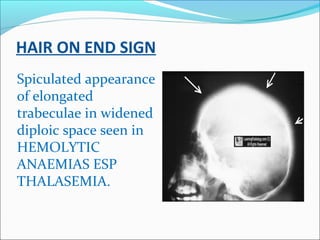 Radiology signs | PPT